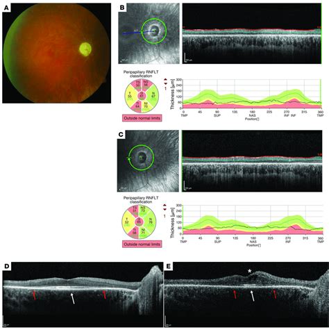 Ophthalmologic Phenotype Associated With The P G40v Ssbp1 Mutation In Download Scientific