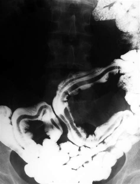 Severe Large Ascariasis Radrounds Radiology Network