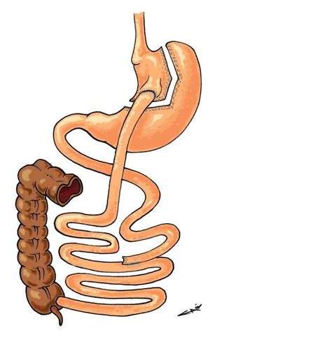 Difference Between Normal And Mini Gastric Bypass Rgastricbypass