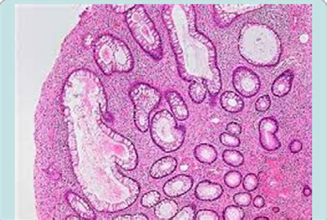 Juvenile Polyp Depicting Cystic Dilatation Of Glandular Articulations