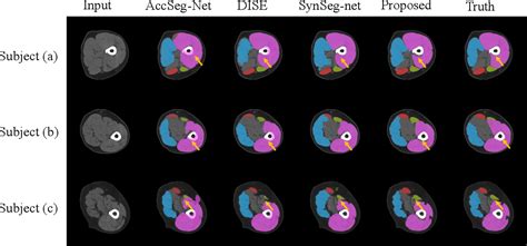 Single Slice Thigh Ct Muscle Group Segmentation With Domain Adaptation And Self Training Paper