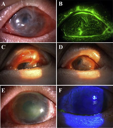 Profound Pannus Ingrowth Onto The Cornea After Limbal Stem Cell
