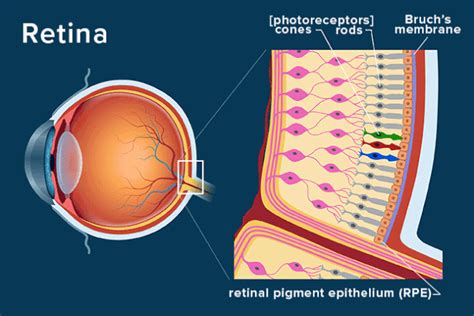 Choroidal Neovascular Membrane Diagram