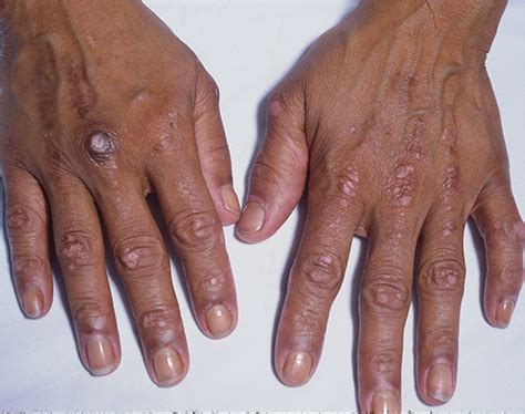 Dermatomyositis School Of Medicine