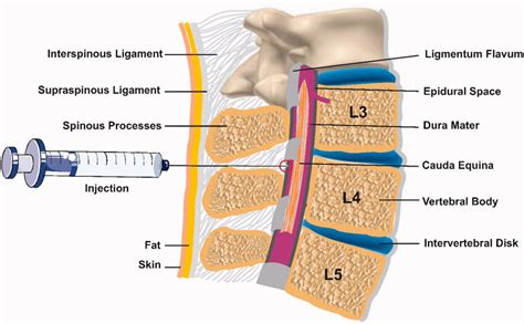 What Is The Definition Of A Epidural Block At Kerry Palacios Blog