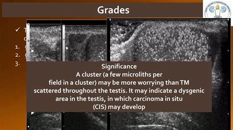 Testicular Microlithiasis Simple Pptx