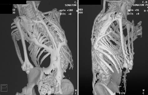 Fibrodysplasia Ossificans Progressiva Fop Hastalığı Belirtileri