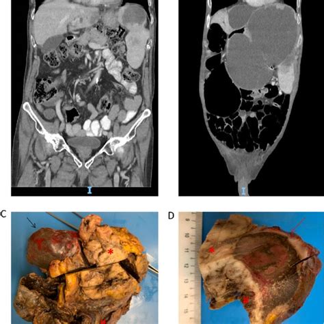 Reported Cases Of Primary Splenic Sarcomas Download Scientific Diagram