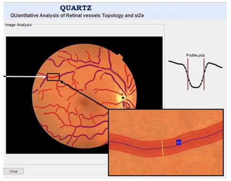 Ai Tool Can Scan A Retina Predict Heart Disease Risk In Under A Minute