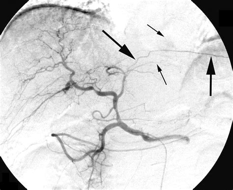 Left Gastric Artery Angiogram
