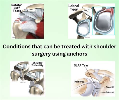 Shoulder Surgery With Anchors Clinicspots