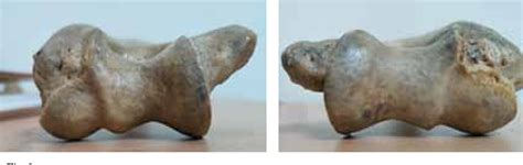 Figure 2 From Sex Determination From Lower End Of Humerus Using