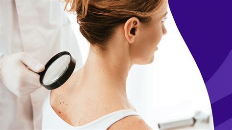 Amoxicillin Rash Causes Duration And Treatment