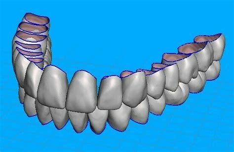 Obj File Teeth For Temporary Crowns Maxillarymandibular Teeth・design