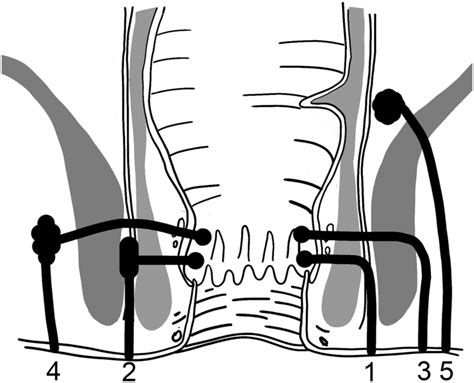 Diagrammatic Schema Of The St Jamess Classification 1 Grade 1
