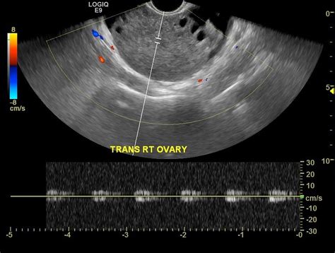 Ovarian Torsion Ultrasound