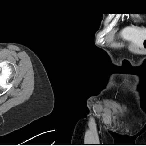 CT Scan Images Of A Year Old Woman Who Presented With Acutely Download Scientific Diagram