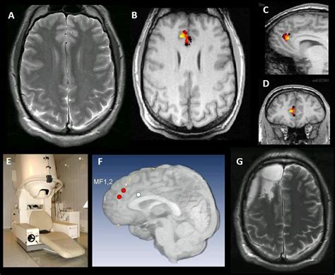 Operate Now Epilepsy Surgery