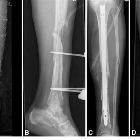 Pdf Segmental Tibial Fractures An Infrequent But Demanding Injury