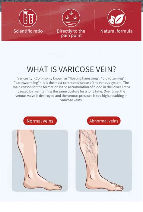 Varicose Veins Patch 2024 Medical Varicose Compression Plaster For