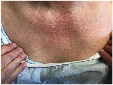 Dermatomyositis Paraneoplastic Syndrome