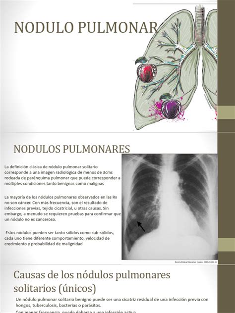 Nodulo Pulmonar Pdf