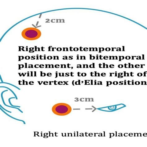 Shows The Positioning Of A Right Unilateral Rul Electrode Placement [36] Download