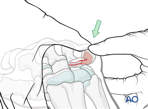 Orif For Dislocation And Fracture Dislocation Of The Carpometacarpal Joints
