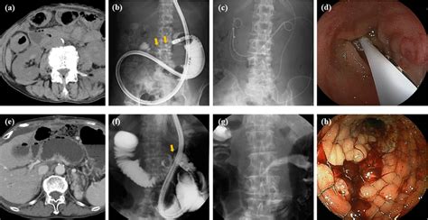 Double‐balloon Endoscopic Procedure For Benign And Malignant Afferent Download Scientific