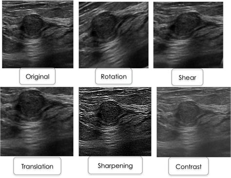 Transfer Learning For Breast Lesion Detection From Ultrasound Images