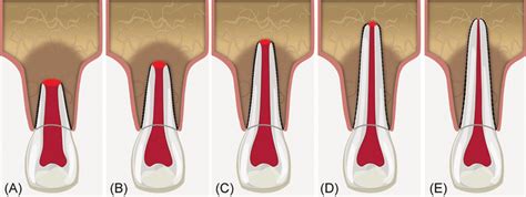 Schematic Of Cveks Stages Of Root Development A Group I