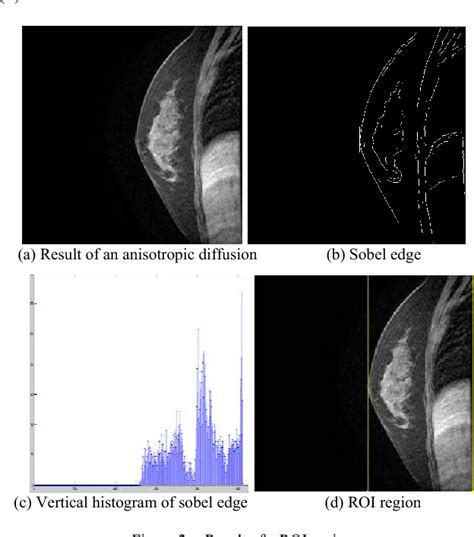 Figure 1 From Segmentation Of The Pectoral Muscle Boundary In Breast Mr Images Semantic Scholar