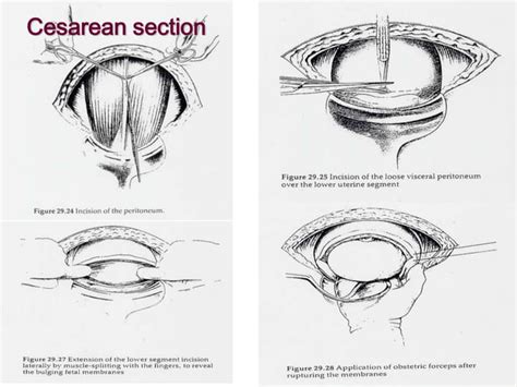 8 Cesarean Section Pptx