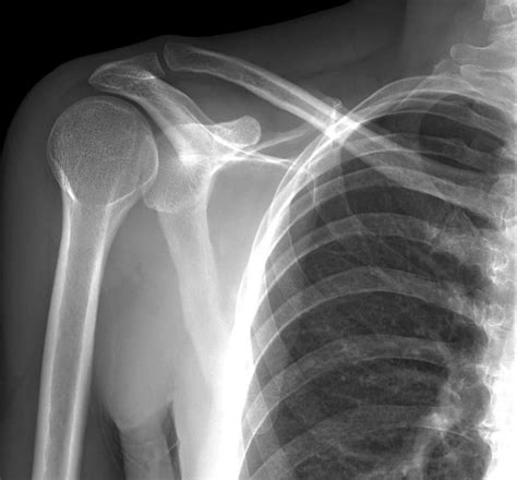 what is a partial dislocation called at marcus dacomb blog