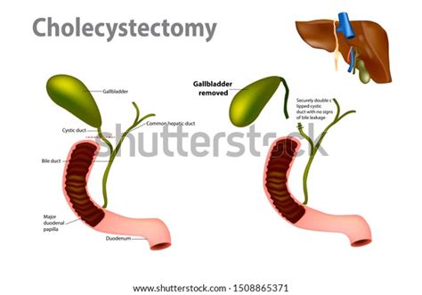 Gallbladder Removal Surgery Laparoscopic Cholecystectomy Stock Vector Royalty Free