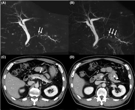 Mrcp Findings And Ct Findings A Mrcp Showed Stenosis Of The Mpd Download Scientific Diagram