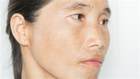 How To Get Rid Of Spot Scars And Acne Marks Amedics Clinic