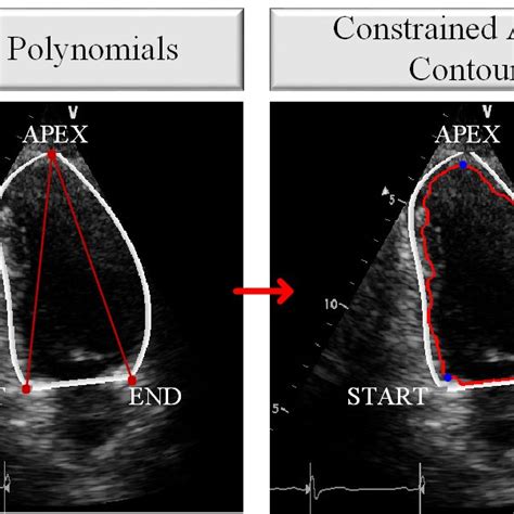 The Aps Method For The Endocardial Boundary Of The Lv Wall Extraction