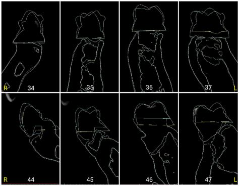 three dimensional superimposition between the initial cbct blue and