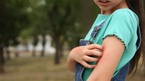 Yuk Cari Tahu Penyebab Dan Penularan Scabies Klikdokter