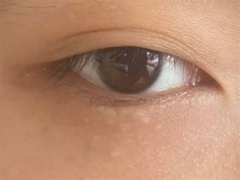 19岁学生出现汗管瘤良性肿瘤应用激光治疗效果好 有来医生