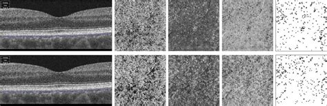 Measurement Of Hyperreflective Foci On En Face Oct First Column Download Scientific Diagram
