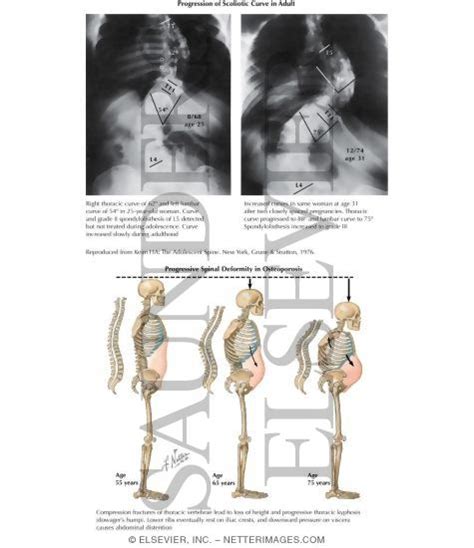 Progression Of Scoliotic Curve In Adult