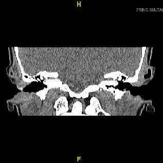 A CT Scan Of Temporal Bone Coronal Cut Download Scientific Diagram