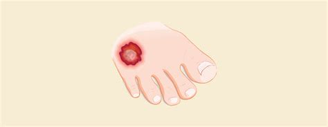 Difference Between Ecthyma Gangrenosum Vs Pyoderma Gangrenosum Knya
