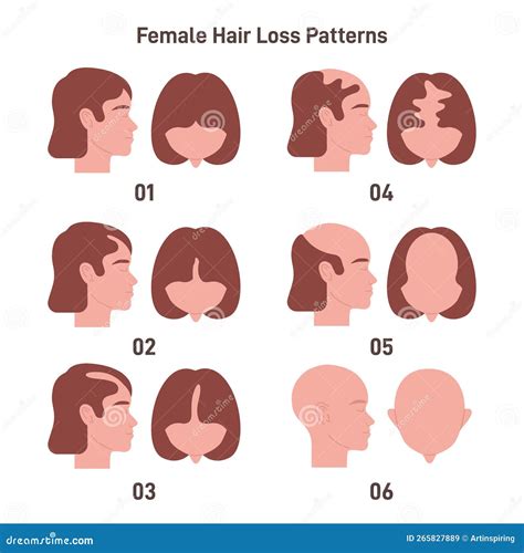 Female Hair Loss Pattern Set Hair Loss Balding Process Female