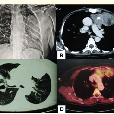 Pdf Primary Primitive Neuroectodermal Tumor Pnet A Rare