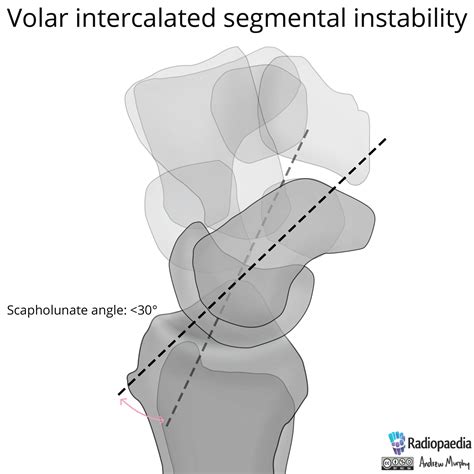 Filenormal Wrist Alignment Dorsal And Volar Intercalated Segmental Instability Illustration