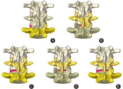 Classification Of Congenital Defect Of The Lumber Facet Joint A Type