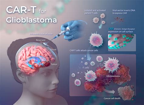 Glioblastoma Treatment Breakthrough 2025 Cdc Nathan Parr